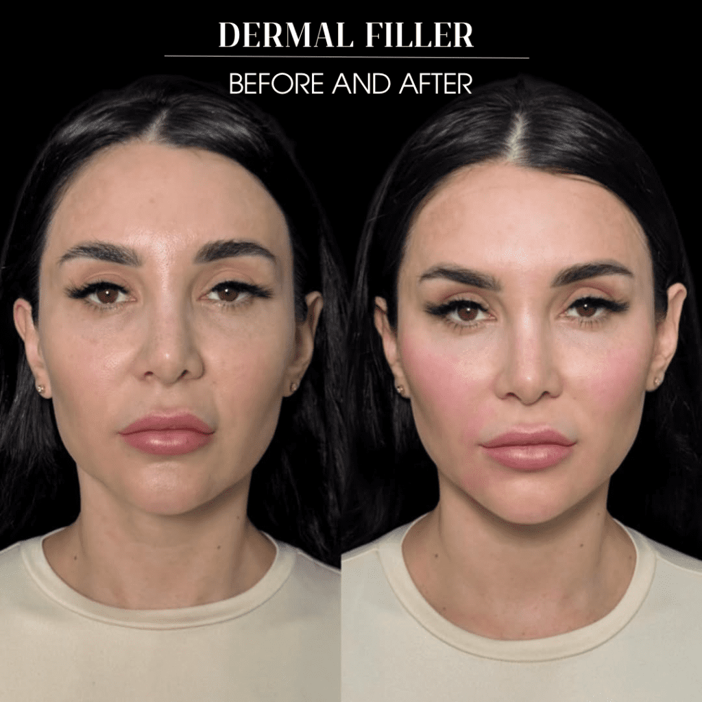 Dermal Fillers in Birmingham | Lips, Cheeks & Jawline – Elenoire